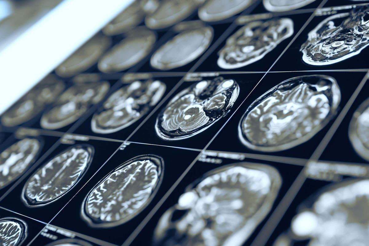 MRI scans reveal the damage long Covid does to your…