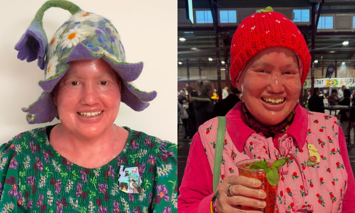 Carly Findlay On Why Using Facial Disfigurement As A…