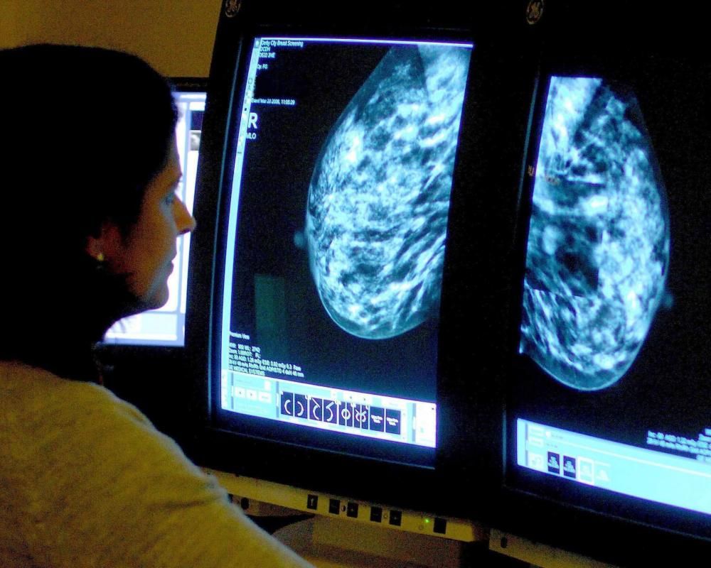 Extra cancer scans for women with dense breasts could…