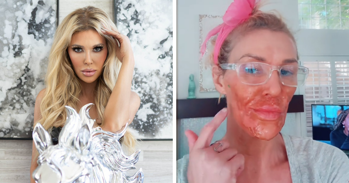 Brandi Glanville Chemically Burns Her Face Desperately…