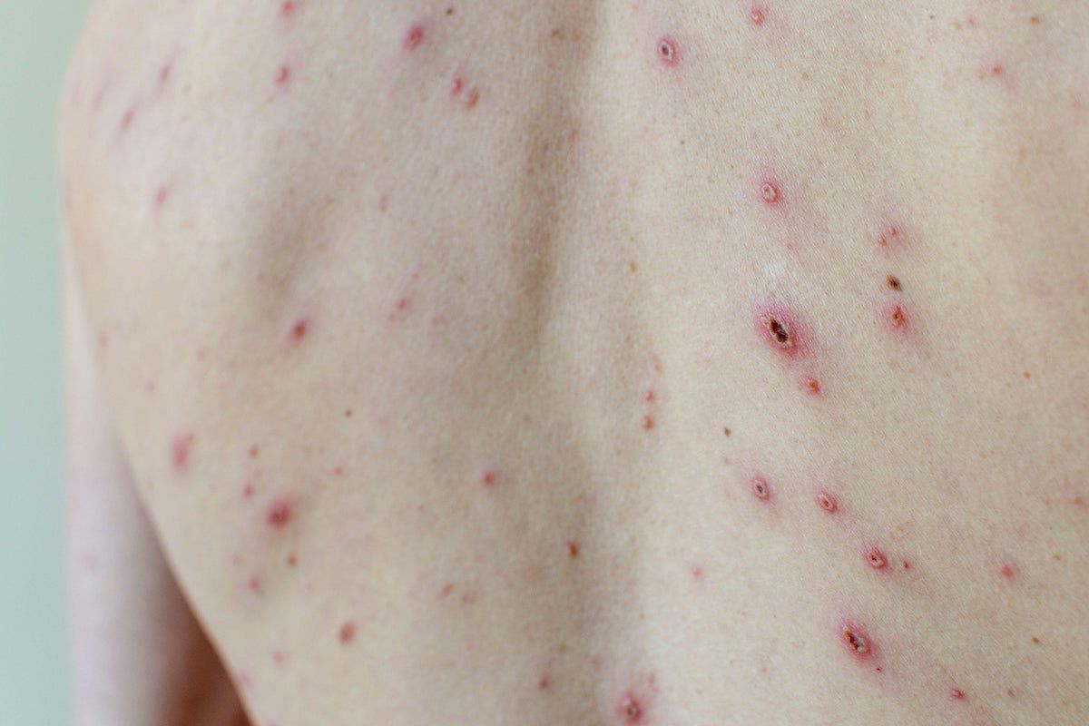 Doctor explains all you need to know about chickenpox…