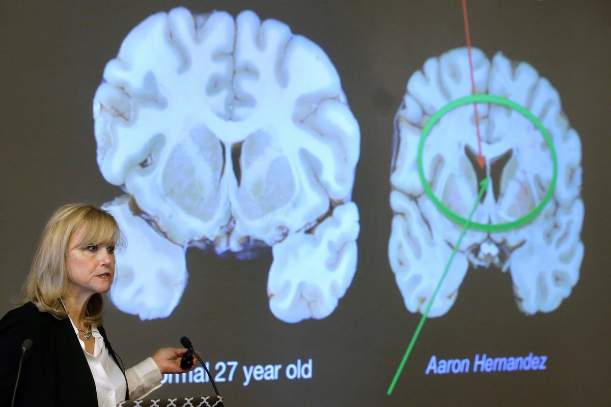 Here's what to know about CTE, the brain disease the…