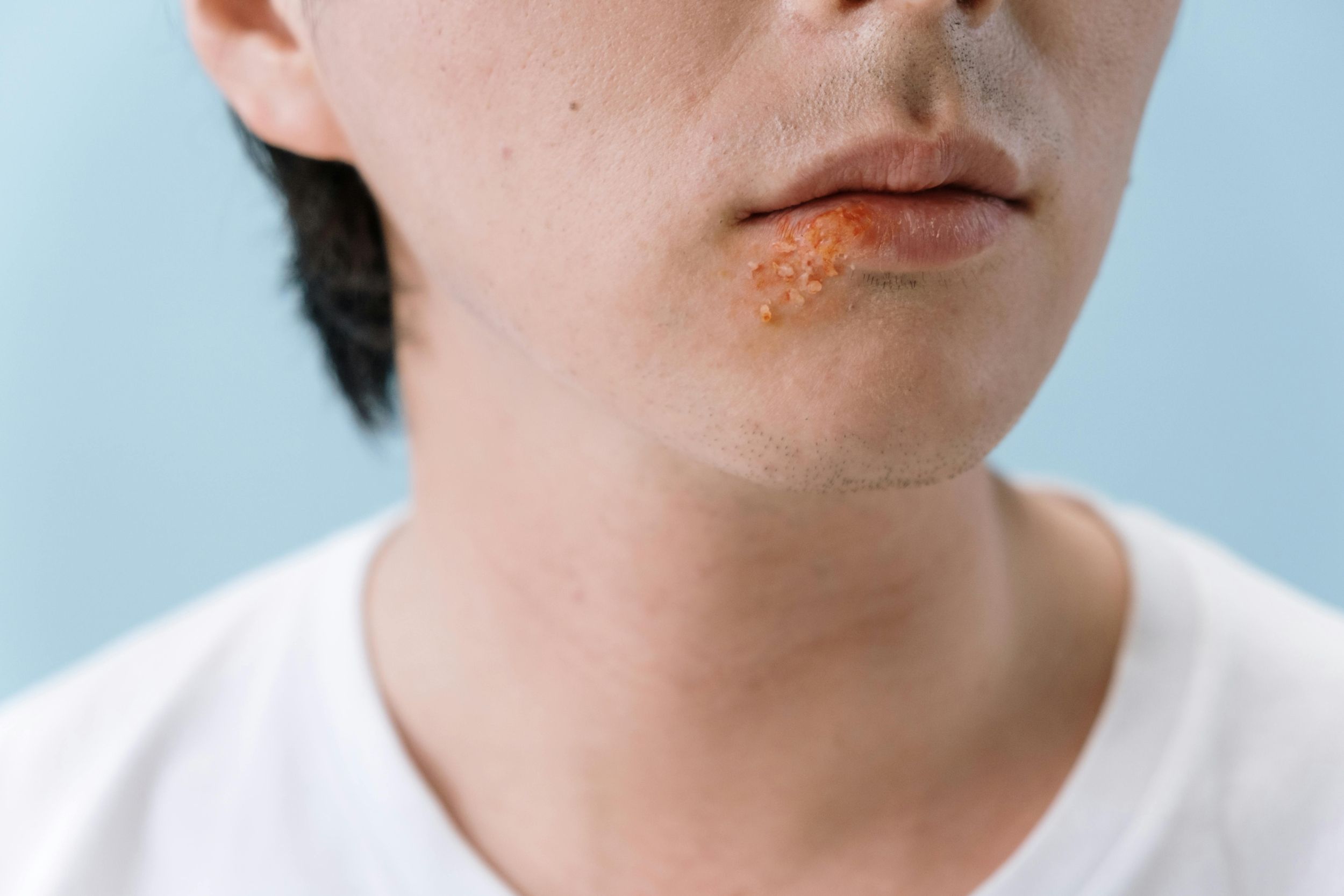 HFMD Symptoms & Contagious Period: How Long This…