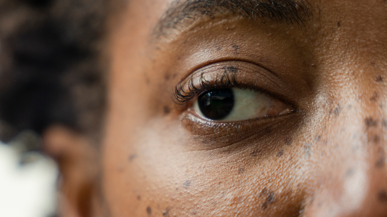 Injecting anesthetic into a 'lazy eye' may correct it,…