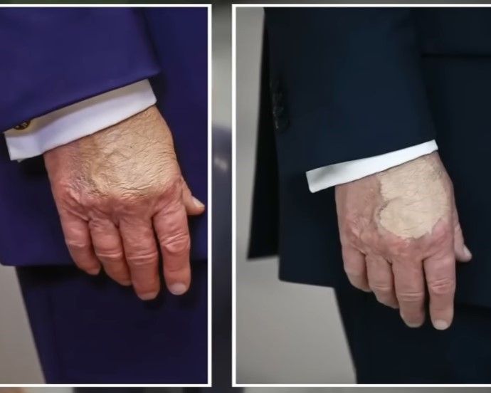 President Donald Trump Applies Makeup To Conceal…