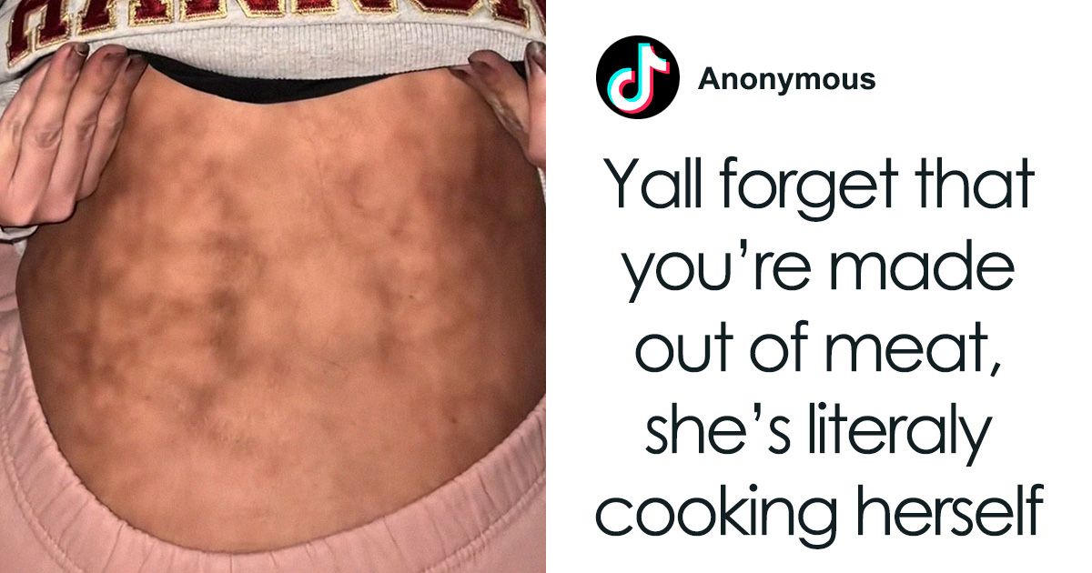 “She’s Literally Cooking Herself”: Woman With ‘Toasted…