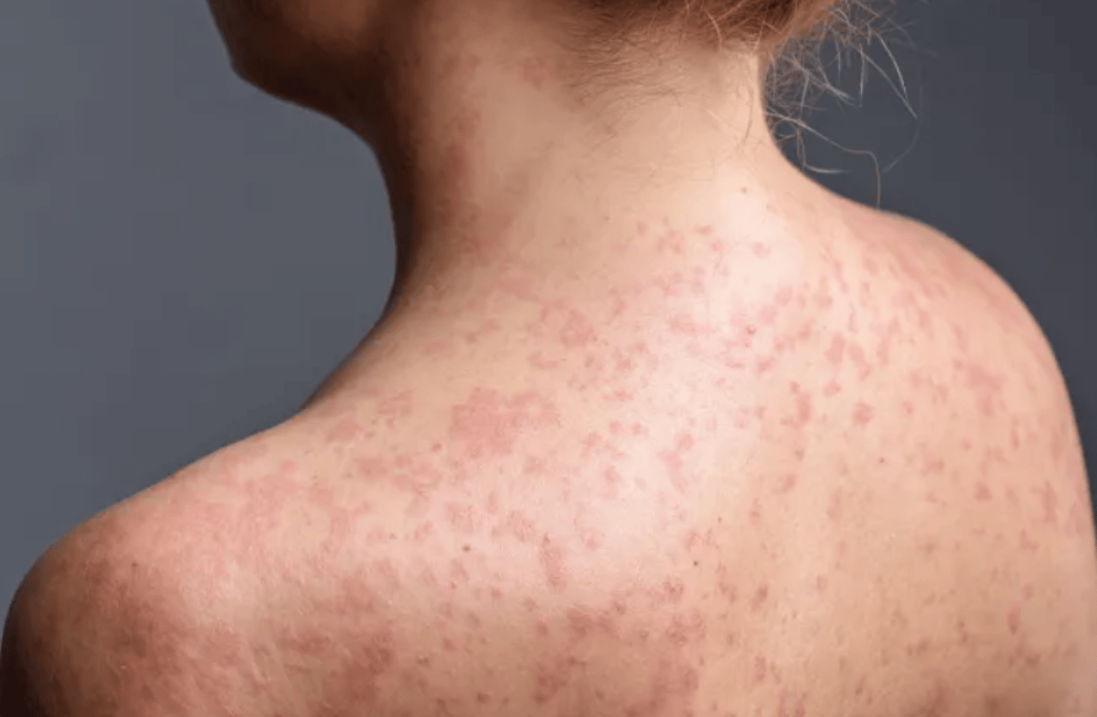 North London measles outbreak continues as cases rise