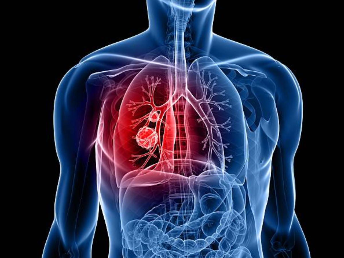 This blood test may reveal lung cancer risk long…