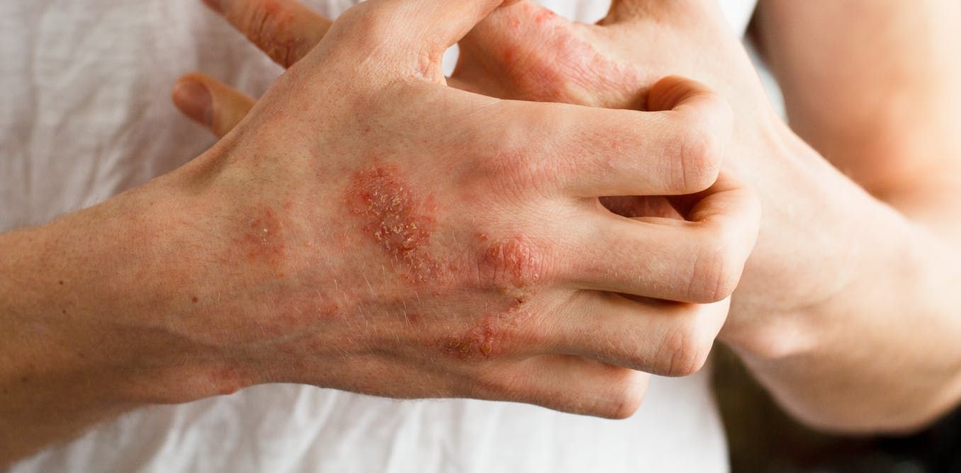 Why simple school sores often lead to heart and kidney…