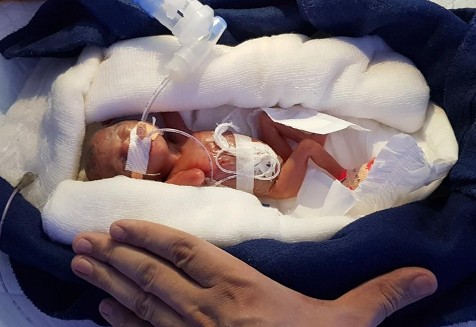 Tiny baby girl born weighing 400 gm survives in Udaipur