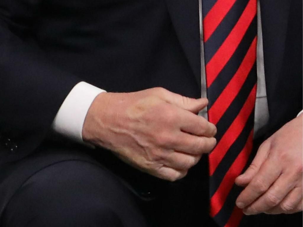 Trump's hand left with thumbprint after Macron…