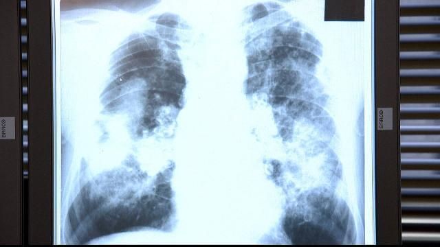 Black lung disease reappears in the US