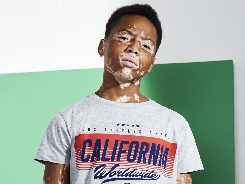 Primark praised for featuring model with vitiligo in…