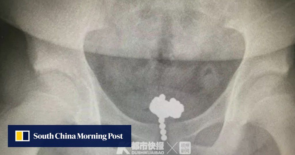 Chinese boy has 70 magnetic balls surgically removed…