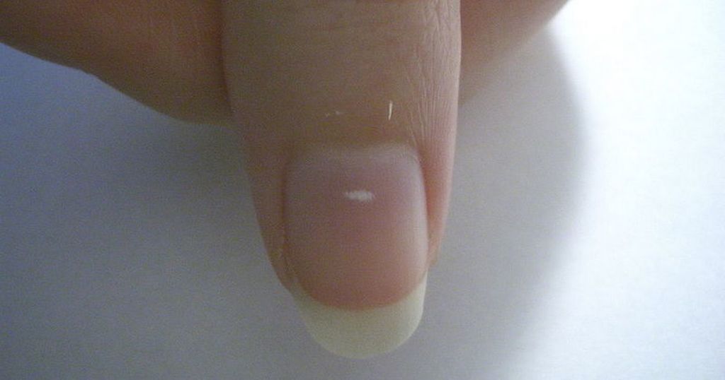 Why You Get White Spots On Your Fingernails And It s why-you-get-white-spots-on-your-fingernails-and-it-s