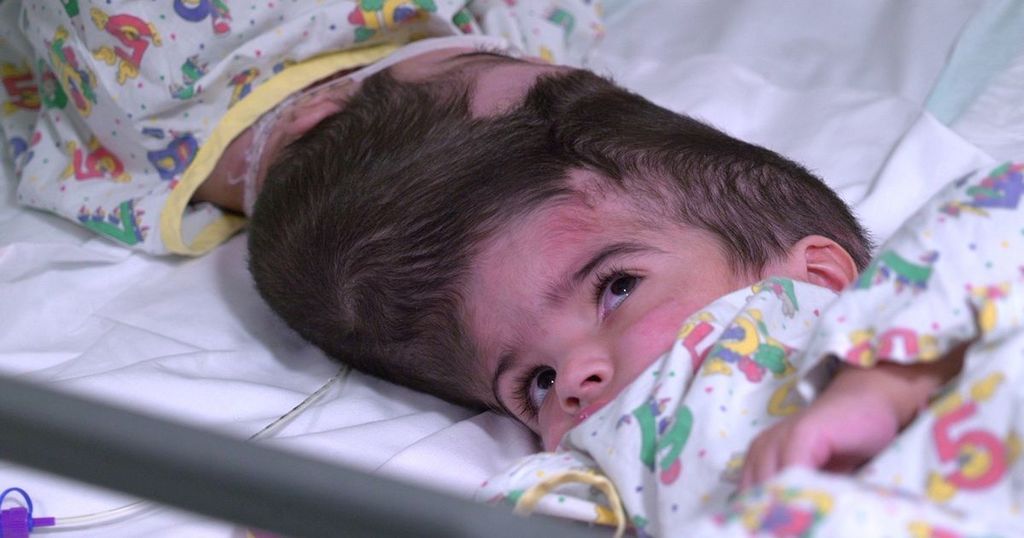 Twins born with skulls fused together separated…