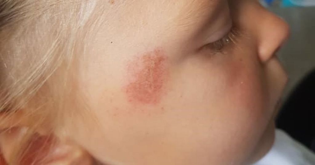 Sisters left with 'throbbing itchy faces' and red…