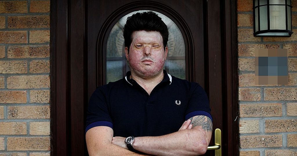 Acid attack victim reveals horror moment he realised…