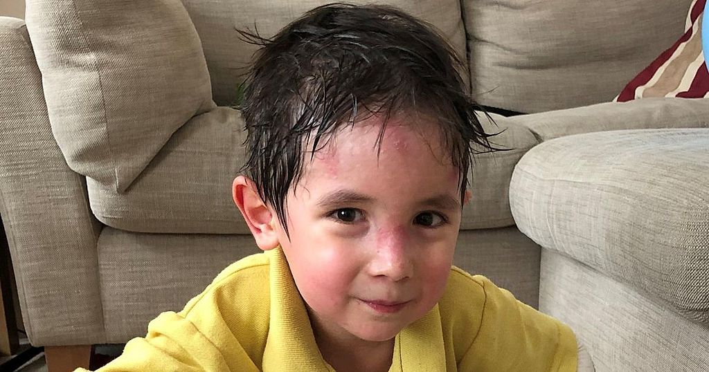 Boy, 5, with 'butterfly skin' suffers third-degree…