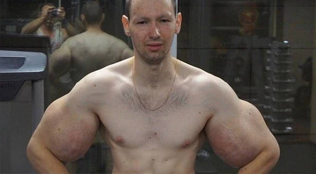 'Popeye' the bodybuilder undergoes procedure to shrink…