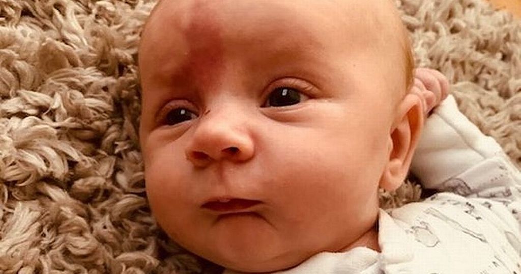 Baby born with large 'port wine stain' on face…