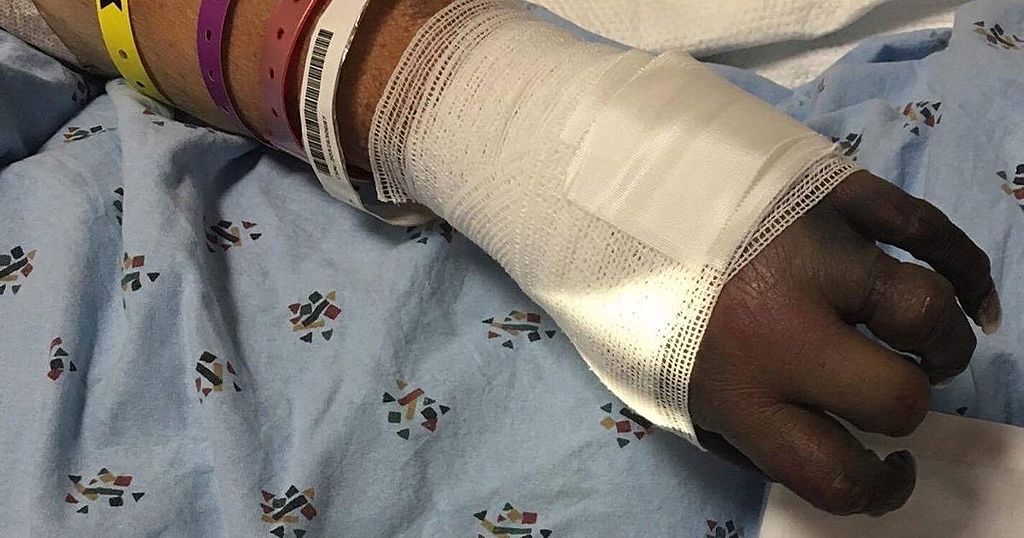 Woman's four limbs amputated after allergic reaction…