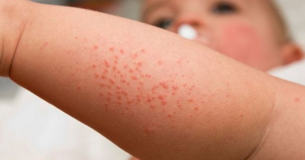 What is Kawasaki disease? These are the symptoms to…